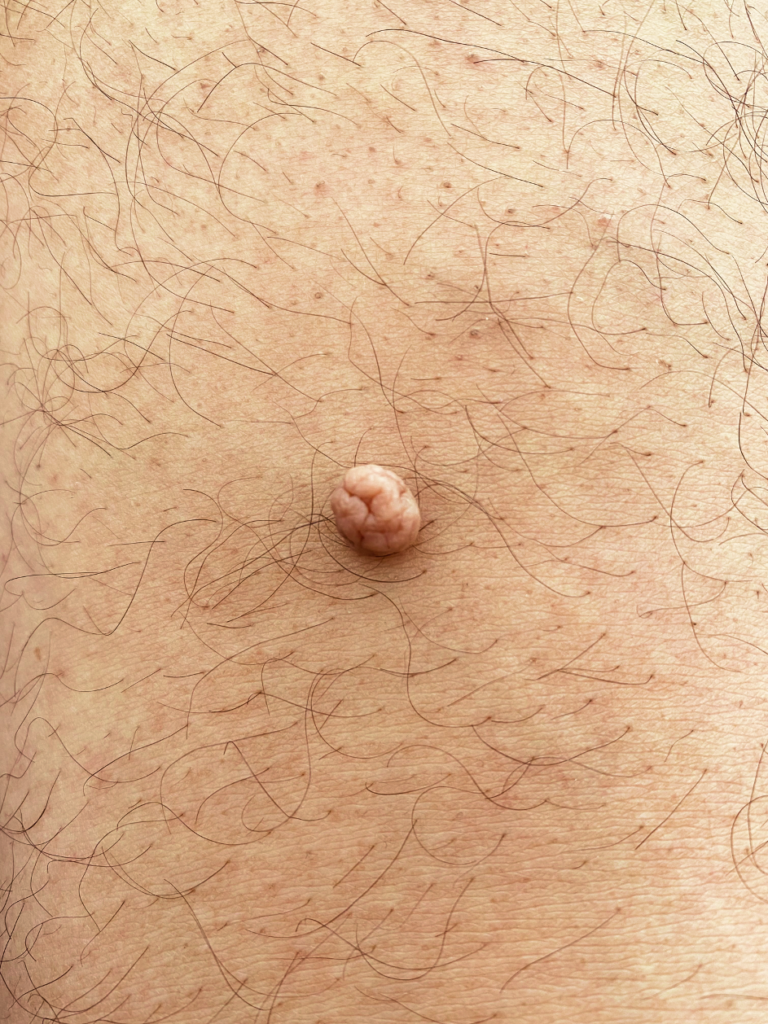 Acrochordon - Dr. Tom Pierunek Médecin lasériste et esthétique Paris