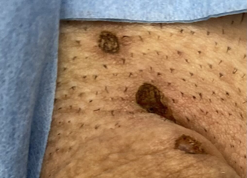 Condylomes - Les verrues génitales - Dr. Tom Pierunek Médecin lasériste ...