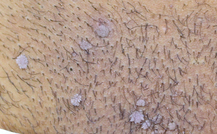 Condylomes - Les verrues génitales - Dr. Tom Pierunek Médecin lasériste ...