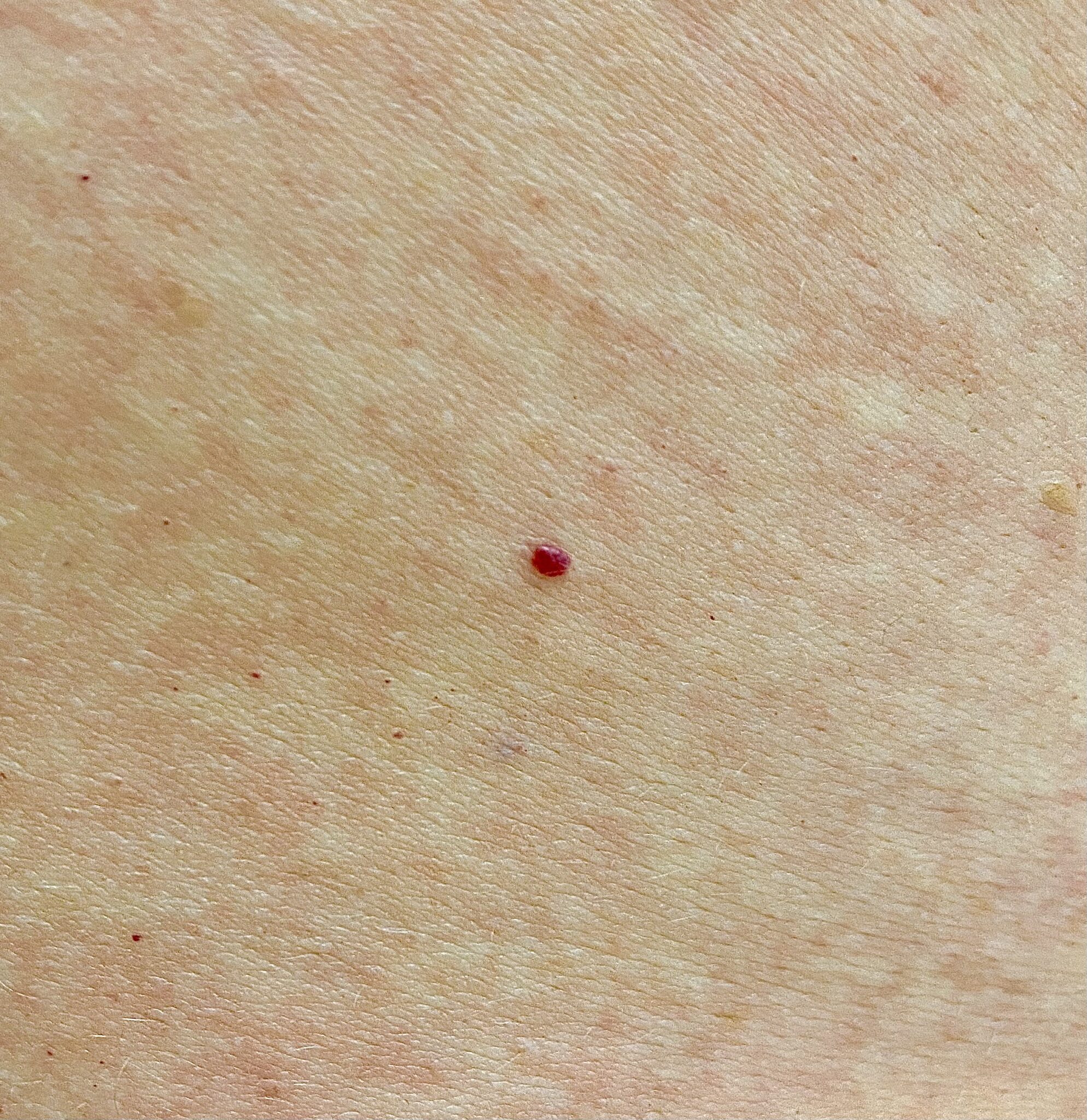 Taches rubis : petits angiomes rouges sur le corps - Dr. Tom Pierunek ...