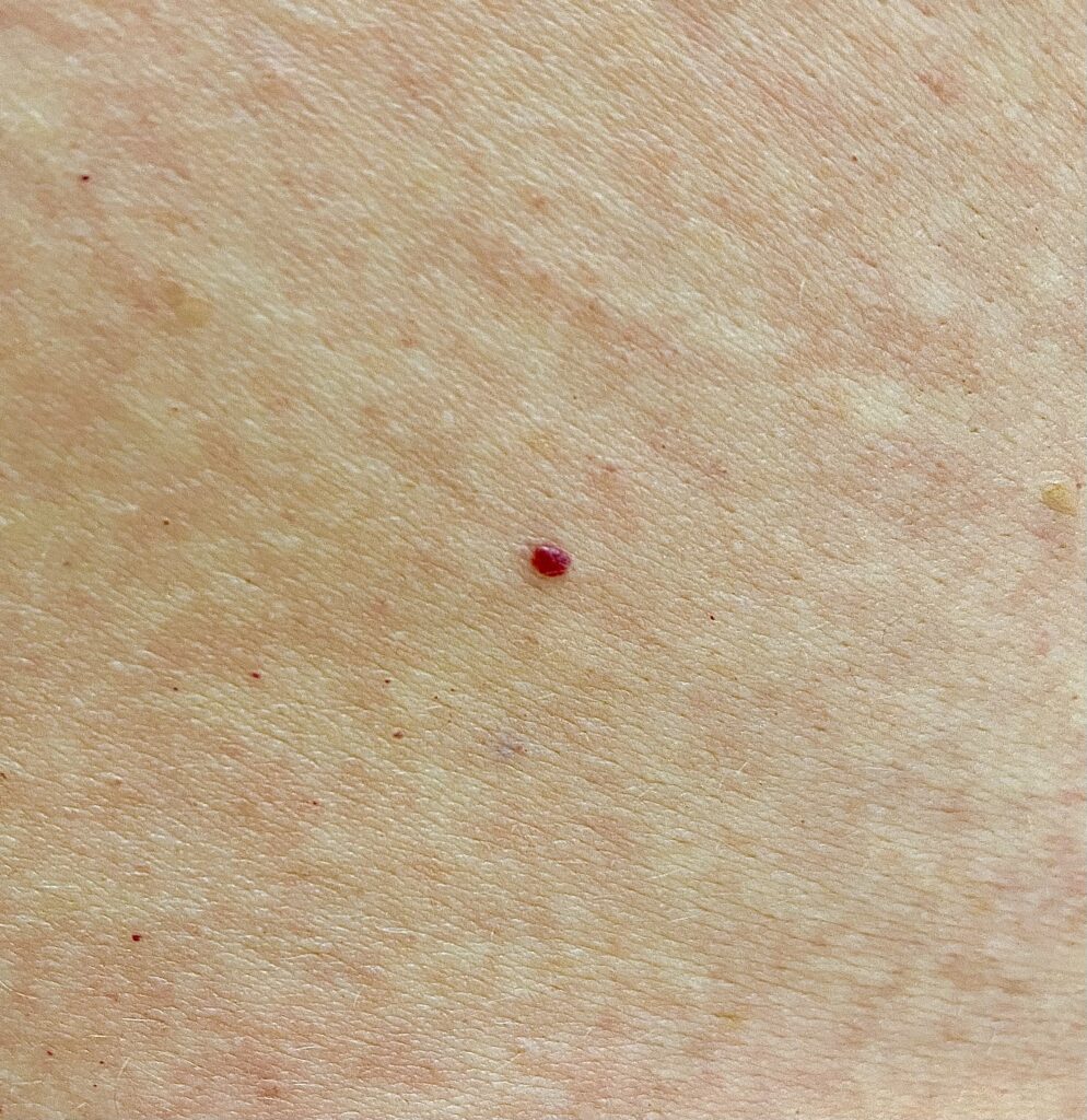 Taches rubis : petits angiomes rouges sur le corps - Dr. Tom Pierunek ...