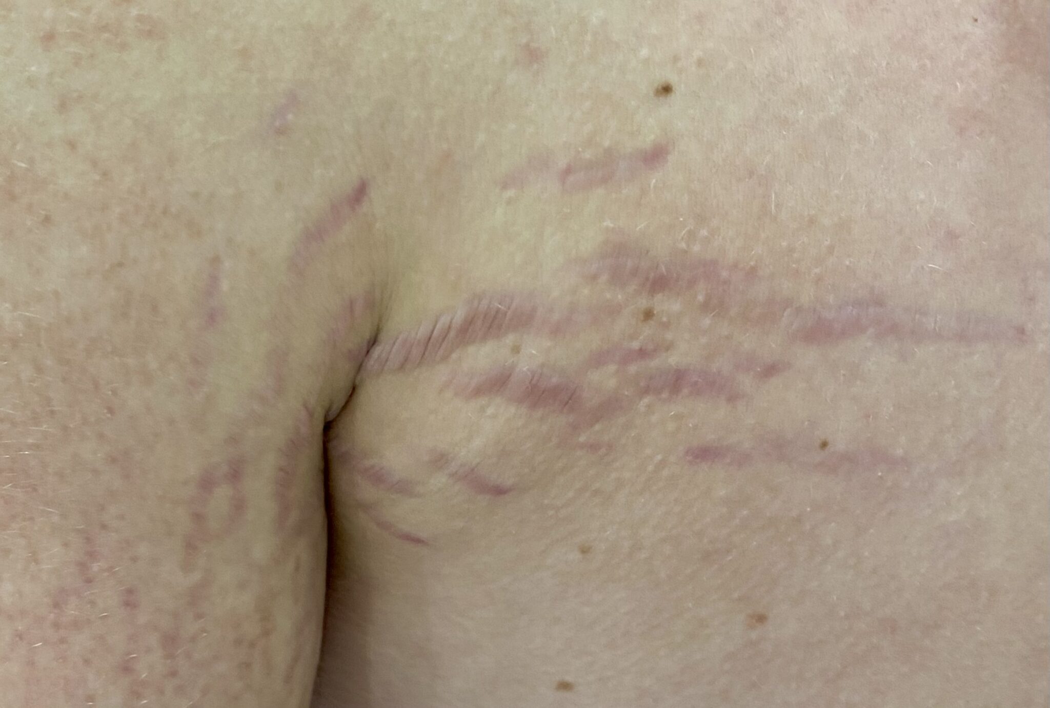 Les vergetures pourpres : Origine, évolution et traitement par laser ...